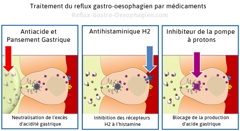 Traitement du reflux gastrique par médicaments (reflux gastro ...