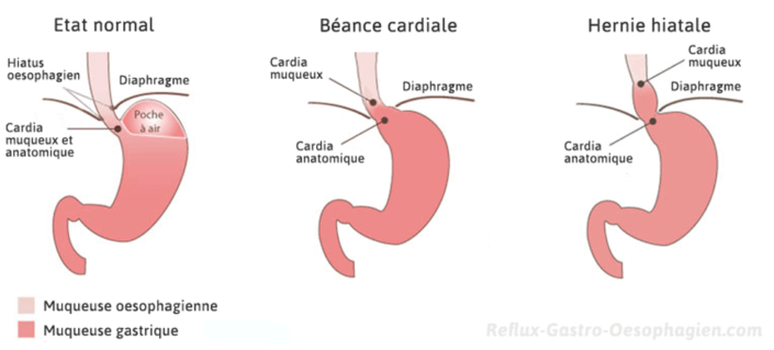 Reflux gastrique durant la nuit : Comment l’atténuer ? - Reflux gastro ...